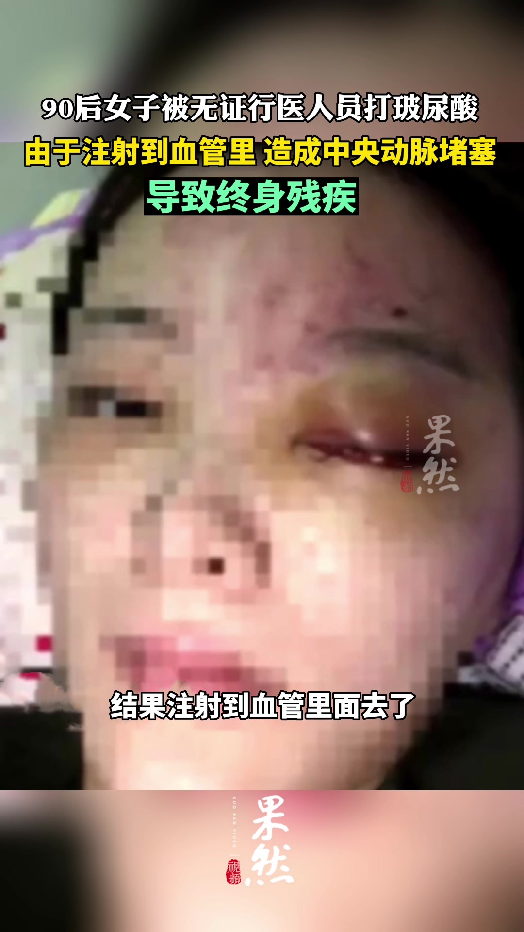 90后女子被无证行医人员打玻尿酸,由于注射到血管里,造成中央动脉...