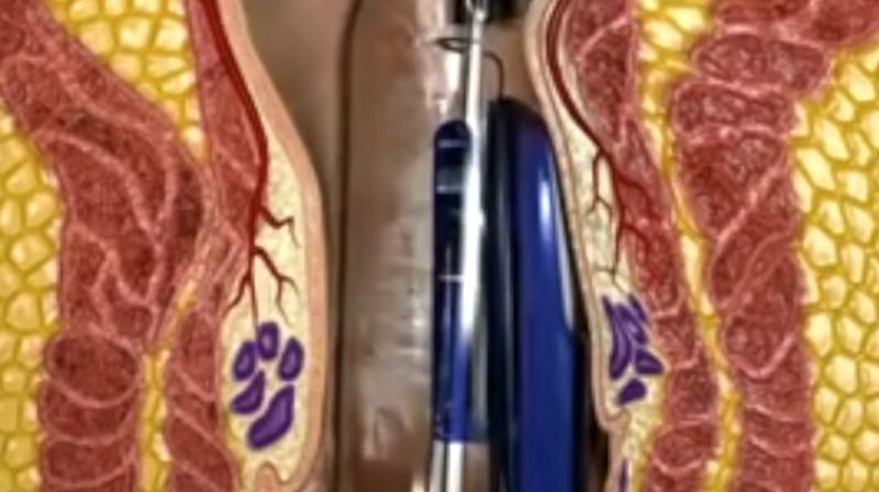 健康课堂:最新的痔疮手术,痔疮兄弟们的福音来了