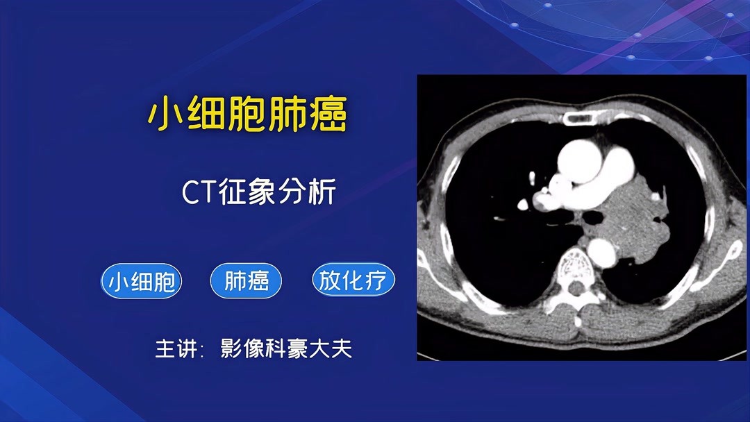小细胞肺癌中心型,CT片怎么分析?与肺鳞癌怎么区别?