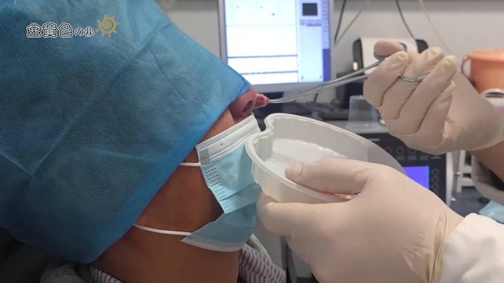 演示:鼻中隔手术后取出鼻腔填塞物