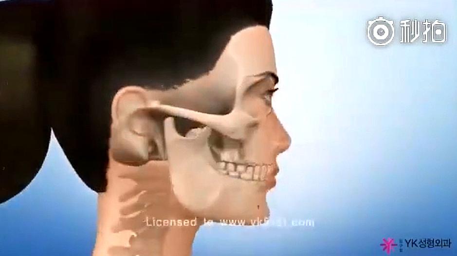 3D动画演示韩国整容术到底是怎么做的,惊悚!