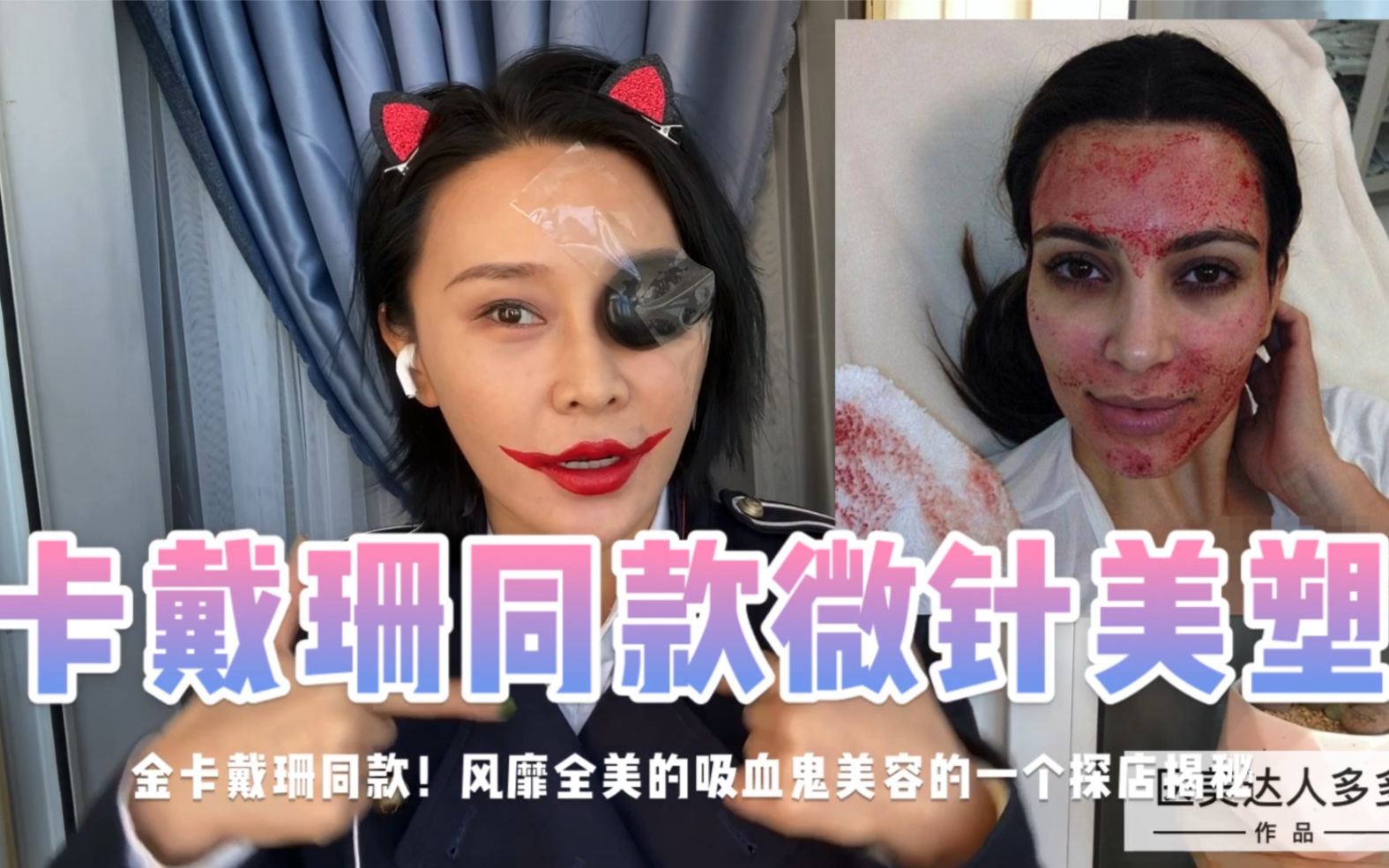 卡戴珊同款吸血鬼美容大揭秘!黄金微针跟传统微针有什么不同?祛痘印...