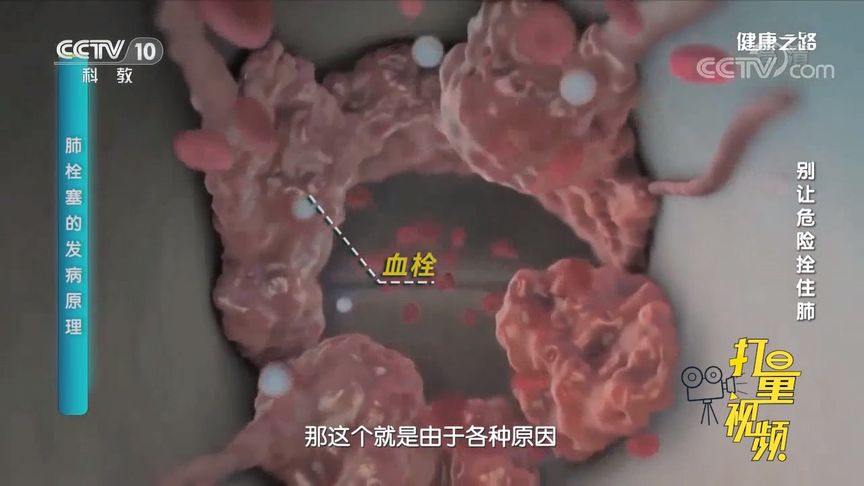 究竟什么是肺栓塞?专家进行讲解,动画演示发病原理|健康之路