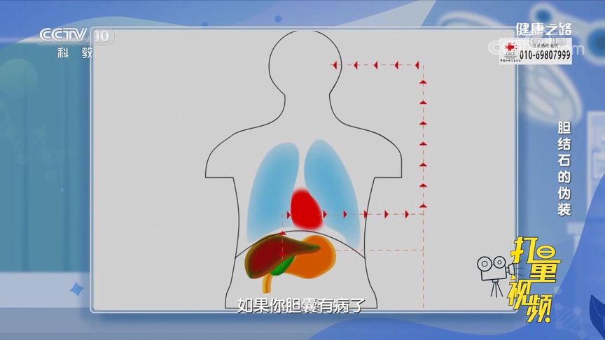 胆结石发作,为什么会引起心脏不适?一段动画演示原理|健康之路