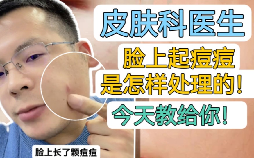 皮肤科医生脸上起痘痘,治疗方法来啦!