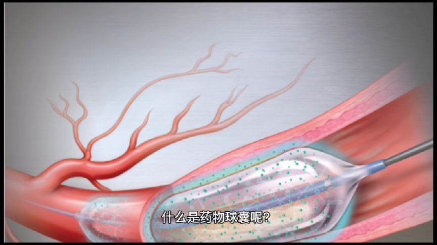药物球囊 vs 金属支架,为急需外科手术患者,赢得宝贵时间