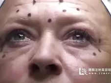医学美容培训肉毒素注射视频