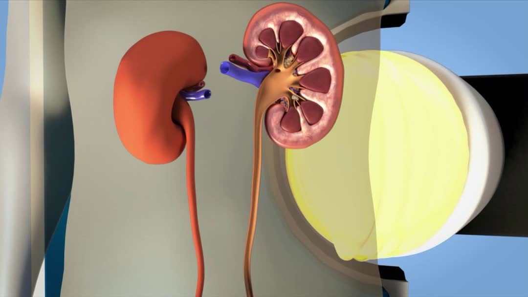 3D动画演示体外冲击波碎石术,了解体外碎石的重要性