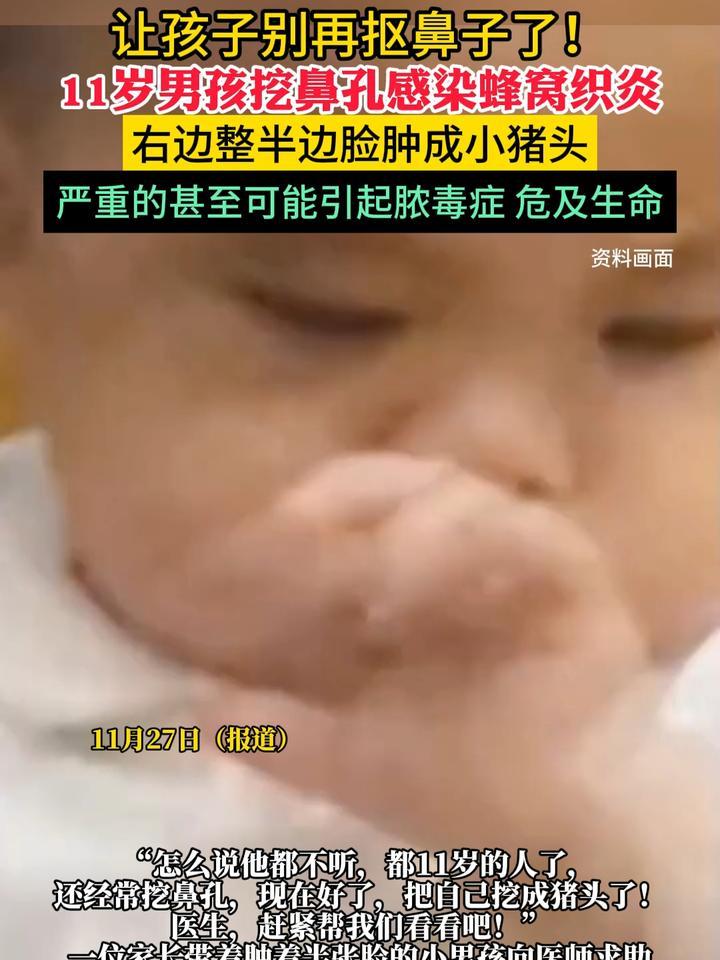 让孩子别再抠鼻子了! 11岁男孩挖鼻孔感染蜂窝织炎 右边整半边脸肿成...