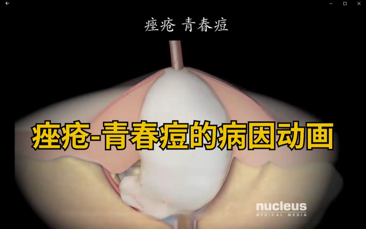 【医学科普】痤疮-青春痘的病因动画