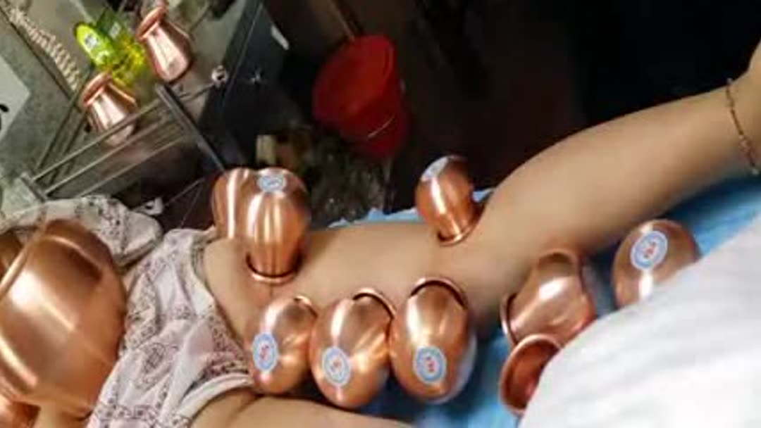 中医拔罐之腿部拔罐