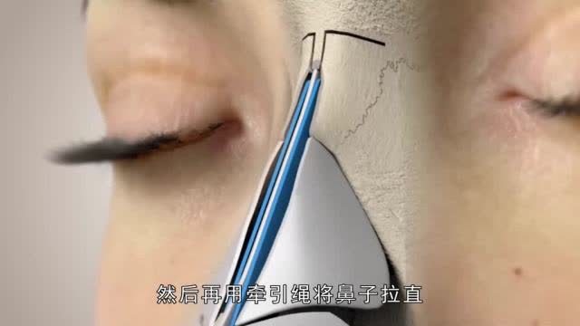 3D动画模拟“隆鼻手术”,画面不忍直视,看完你的爱美之心还有吗