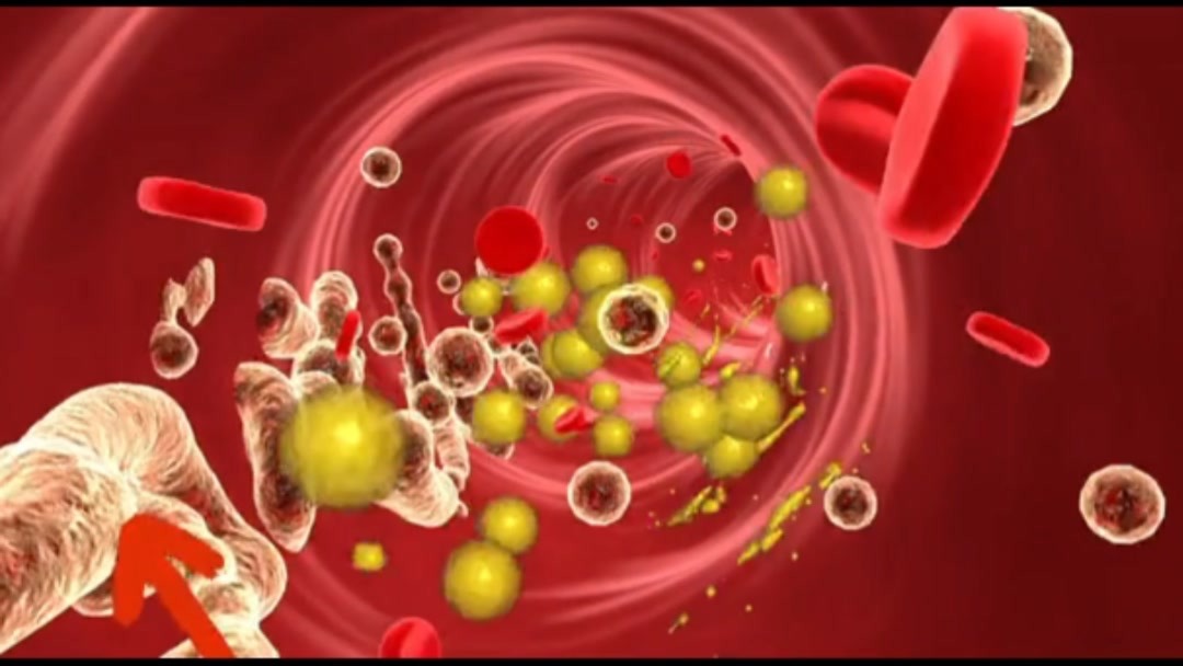 一个视频带你看明白脑血栓的形成