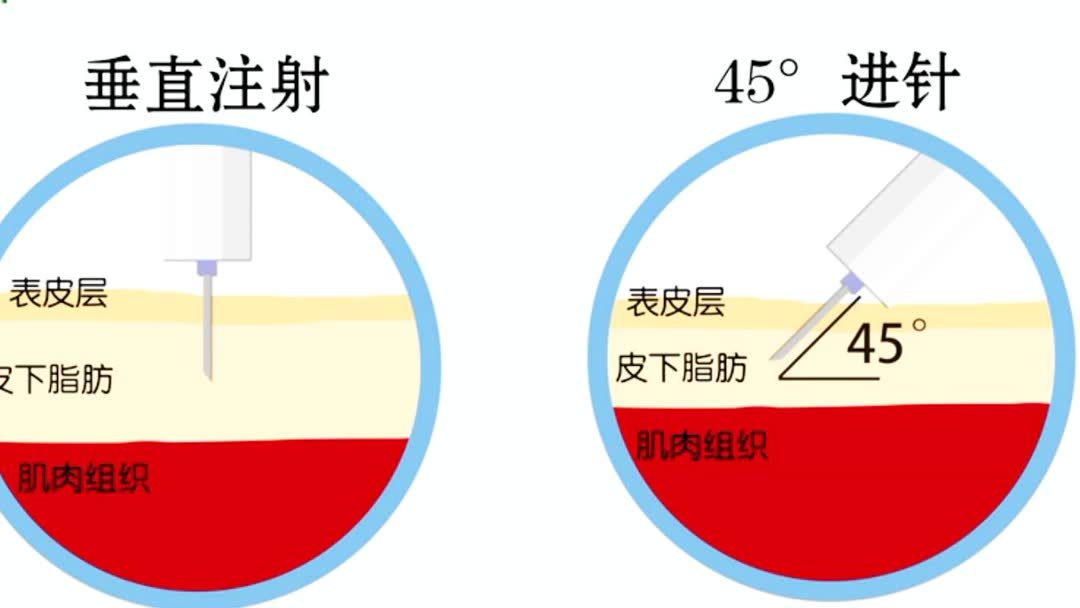 胰岛素注射的实用技巧 这样做才能顺利打入皮下组织保证药效!