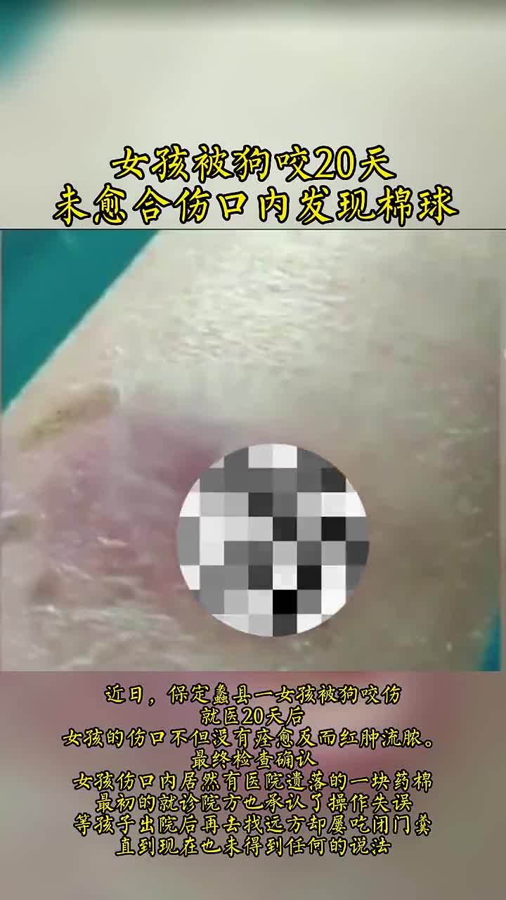女孩被狗咬20天未愈伤口内发现药棉