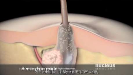 3D动画告诉你长(痤疮)青春痘的原因和正确的处理,千万不能挤
