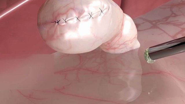 3d医学动画:胆囊结石微创手术治疗过程