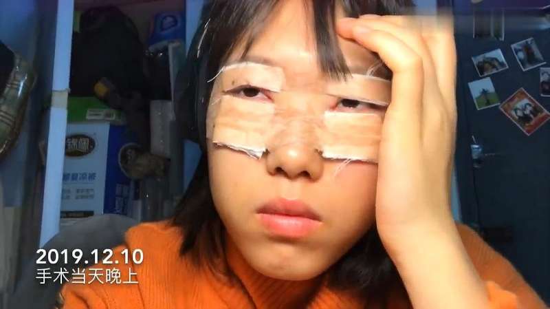 天生肿眼泡的眼综手术30day恢复记录