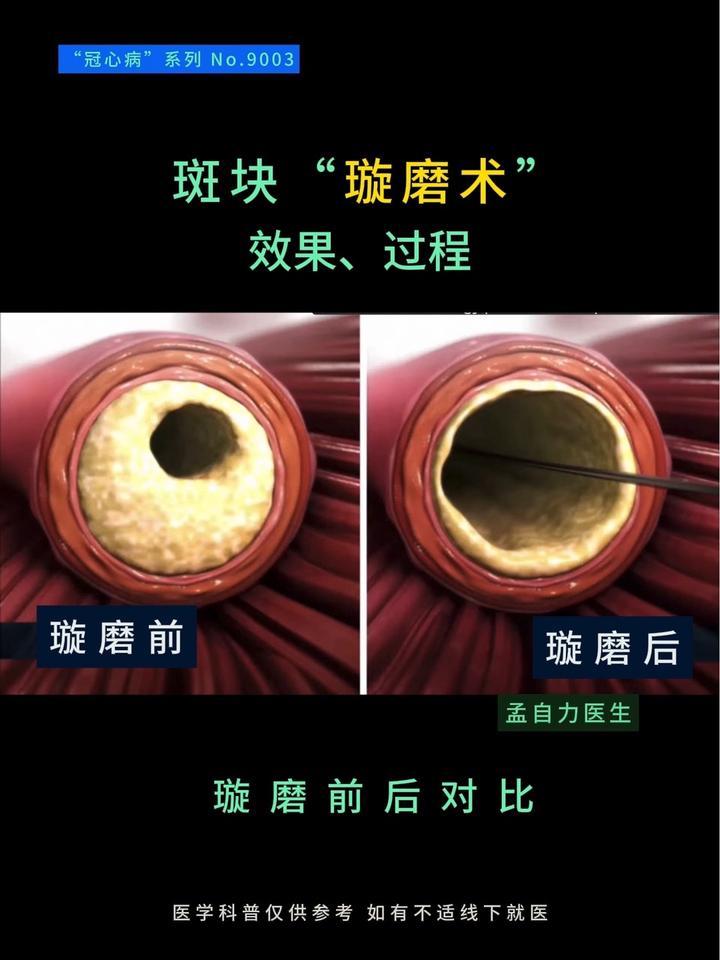 钙化斑块是引起血管狭窄的重要原因,“怎么清除钙化斑块?”有“璇磨...