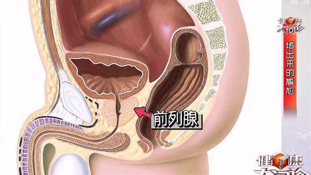 专家利用剖面图,介绍前列腺的位置以及功能,早发现早治疗