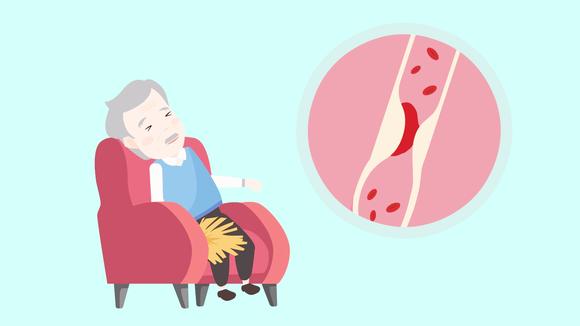 冠状动脉硬化如果只是这种情况,可能不影响寿命,看看你是吗?