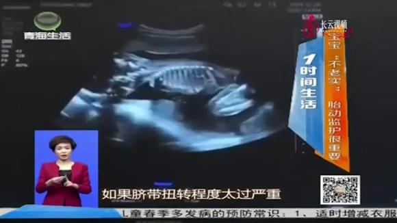孕妈察觉宝宝”不老实“,去医院检查后,发现胎儿脐带扭转了30圈