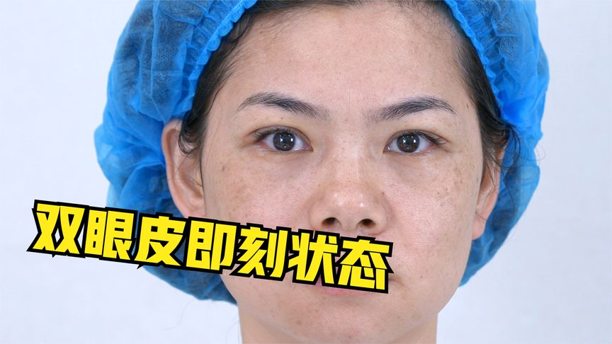 同龄人中较显年轻 只是眼睑处皮肤有所松弛堆积的情况!