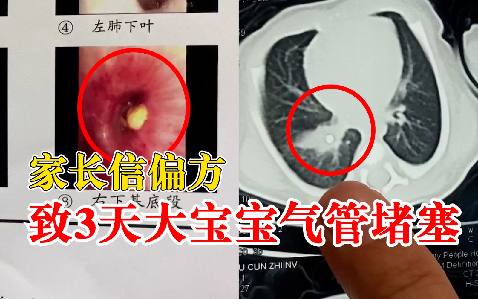 家长信偏方致3天大宝宝气管堵塞:为防宝宝惊夜,听信老人偏方