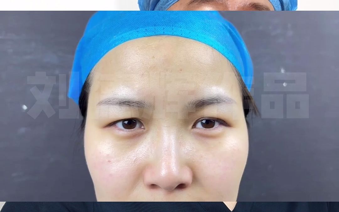 肿眼泡去掉的脂肪还会再长吗