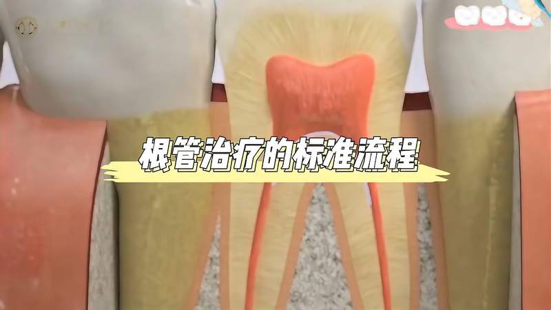 「方津科普」根管治疗的标准流程来啦!