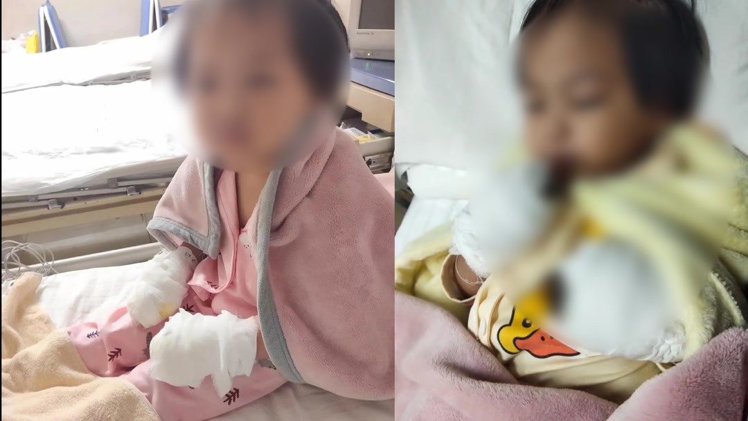4岁女孩将不锈钢筷插进插板,致9根手指被切,术后哭喊不能再画画