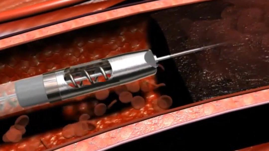 动画展示血栓清除微创手术,跟下水道清淤原理没啥区别