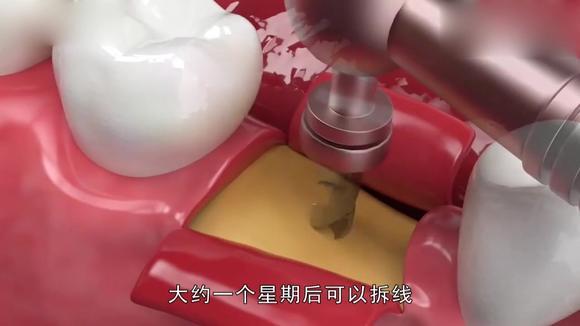 3D动画演示种植牙齿的全过程,看着都疼死了,得亏我牙齿健康!