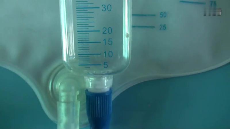 子母式集尿袋精密型尿袋精密型体外引流