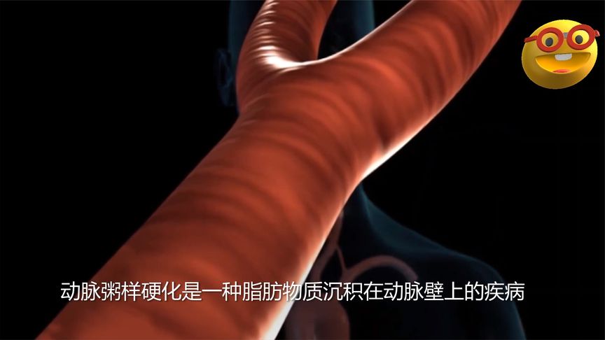 3D演示动脉粥样硬化到血管闭塞的过程,看完后立马要改善生活习惯