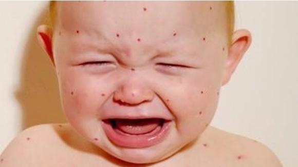 孩子湿疹老复发怎么办?用这类药膏能有效缓解