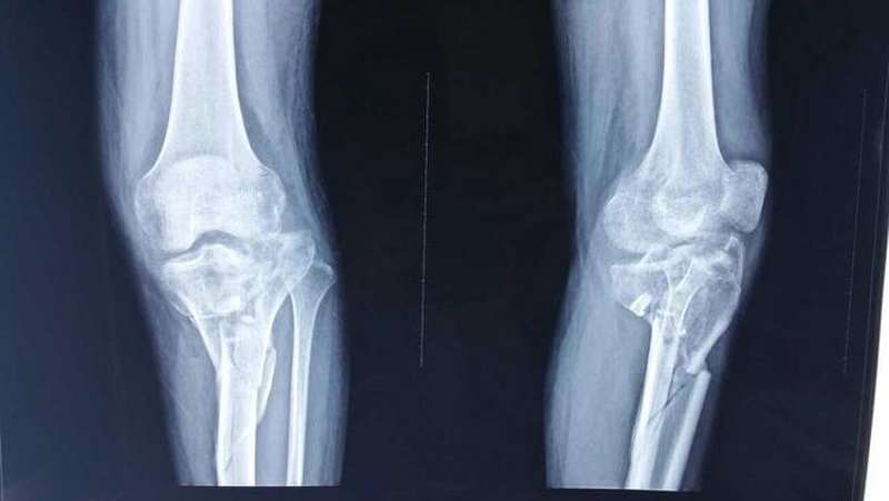 骨折后怎样恢复得快?