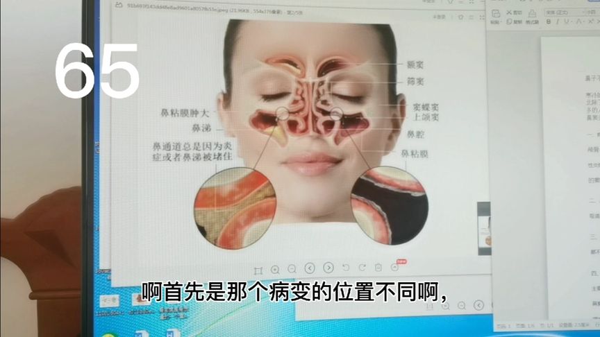 鼻塞流鼻涕打喷嚏,头疼嗅觉障碍,有人说是鼻炎有人说是鼻窦炎