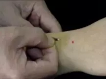 无痛皮下留置针疗法治疗局部痛点——腕部痛点的局部疏拨治疗