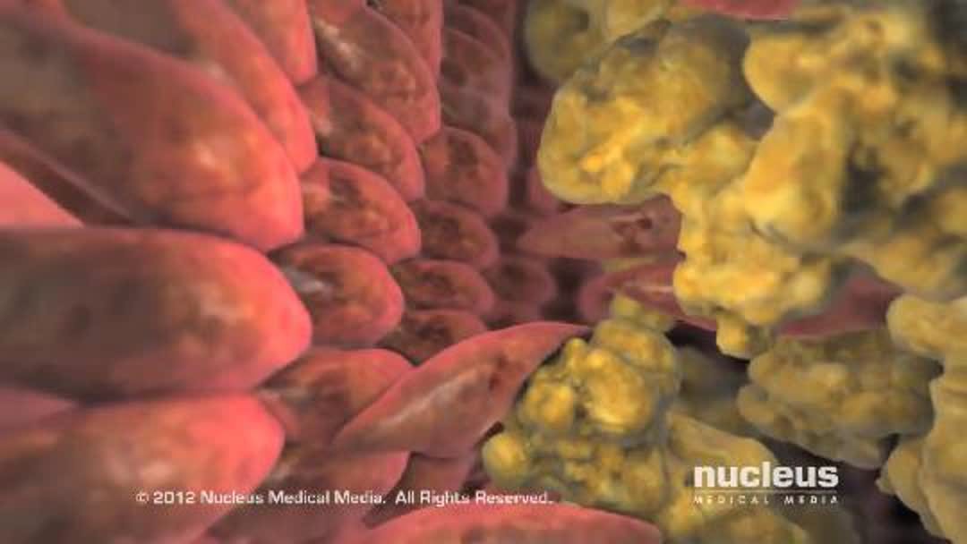 科普,动脉粥样硬化,诱发心血管疾病原因之一!