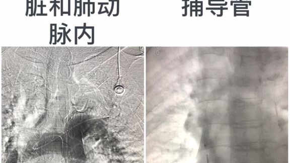 PICC导管不慎滑入心肺巧取出