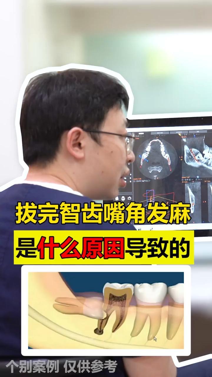 拔除智齿的牙根根尖与下牙槽的神经管密切相连时,可能会引起.