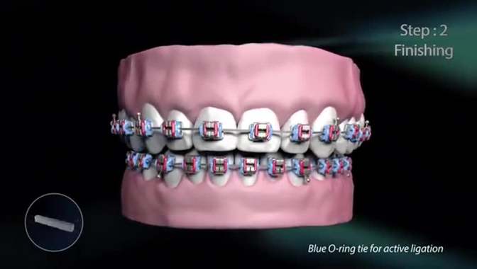 3D动画让你看清真实的牙齿矫正过程原来是这样的!