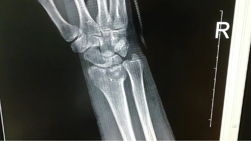 尺桡骨骨折后,一定要预防骨质疏松,关节面破坏更要注意复查!