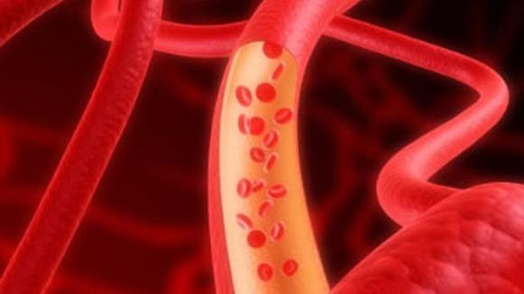 出现这4个症状时,说明血管已经堵塞的很严重了!容易脑梗!