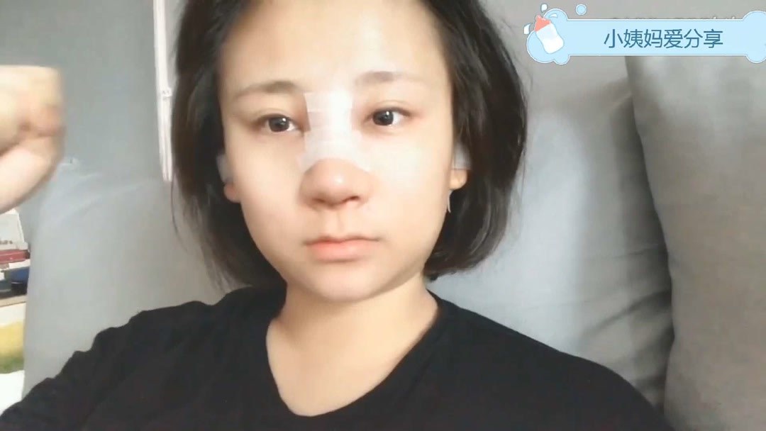 北京鼻综合隆鼻分享十天恢复全过程.完全看不出手术痕迹