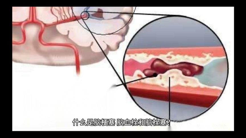 什么是脑梗塞、脑血栓和脑栓塞?