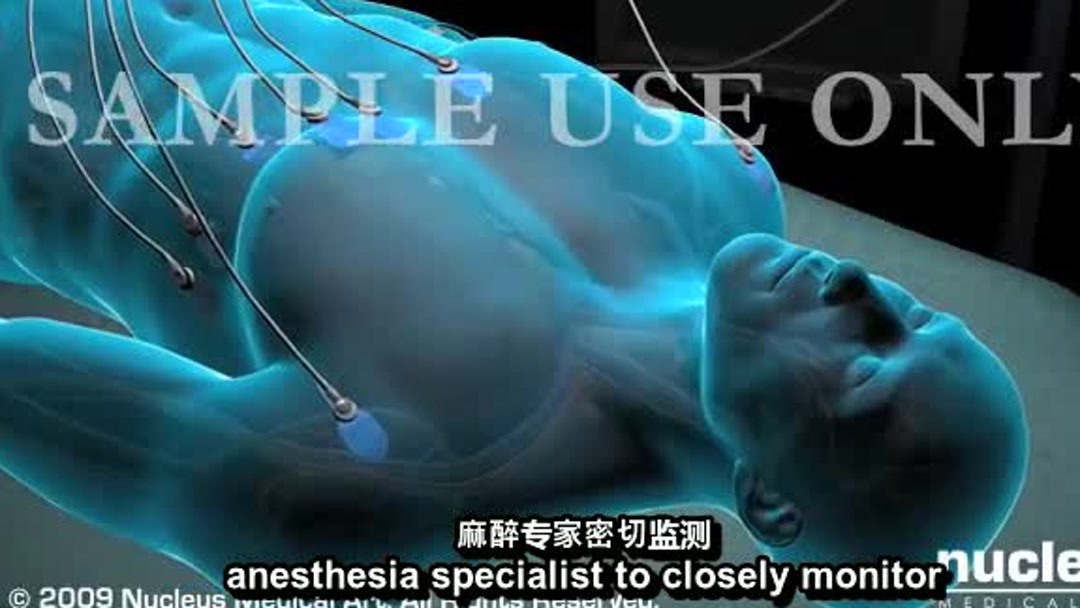 医生必备3D演示动画系列:全身麻醉