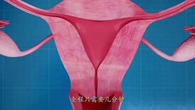 女性取环手术过程,看完全程,宝爸们心疼吗?