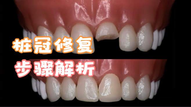 医学动画解说演示桩冠修复步骤,马上让断牙残冠恢复如初